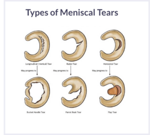 Orthobiologic Cell Treatments for Meniscus Tears And Knee Problems