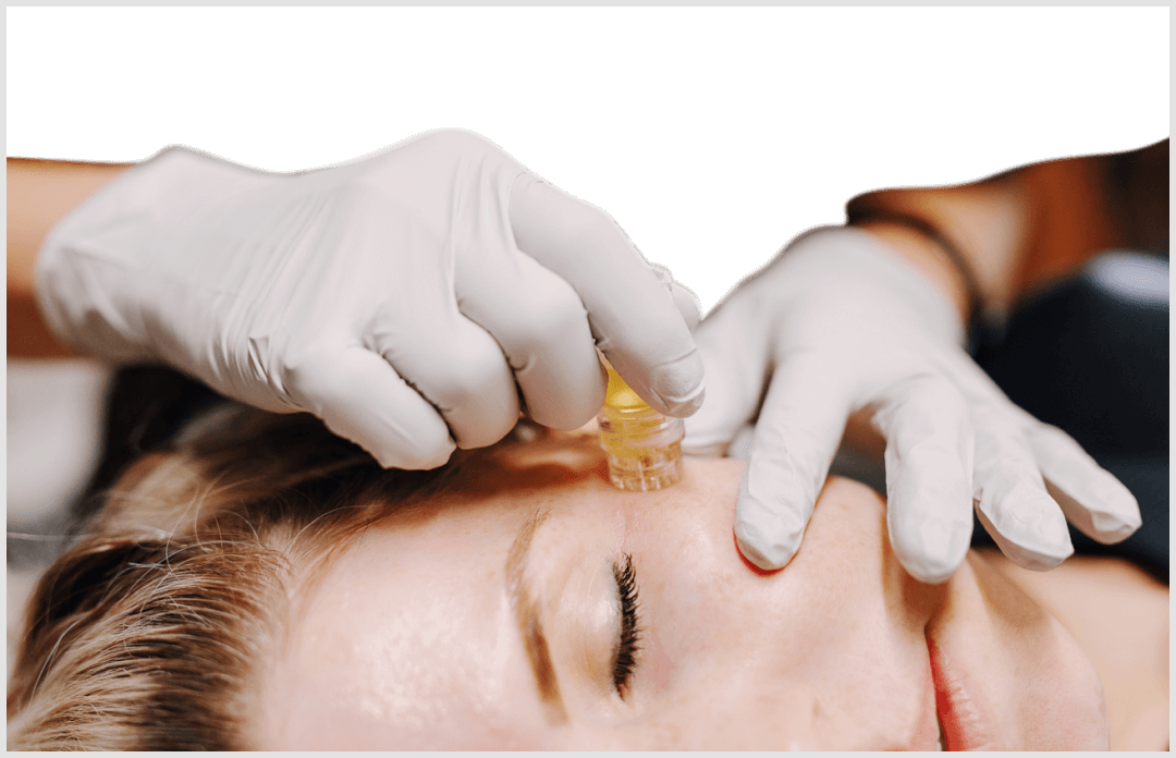 PRP Facial (Platelet-Rich Plasma Facial) or Vampire Facial