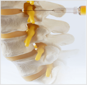 Intradiscal Injections For Lower Back Pain