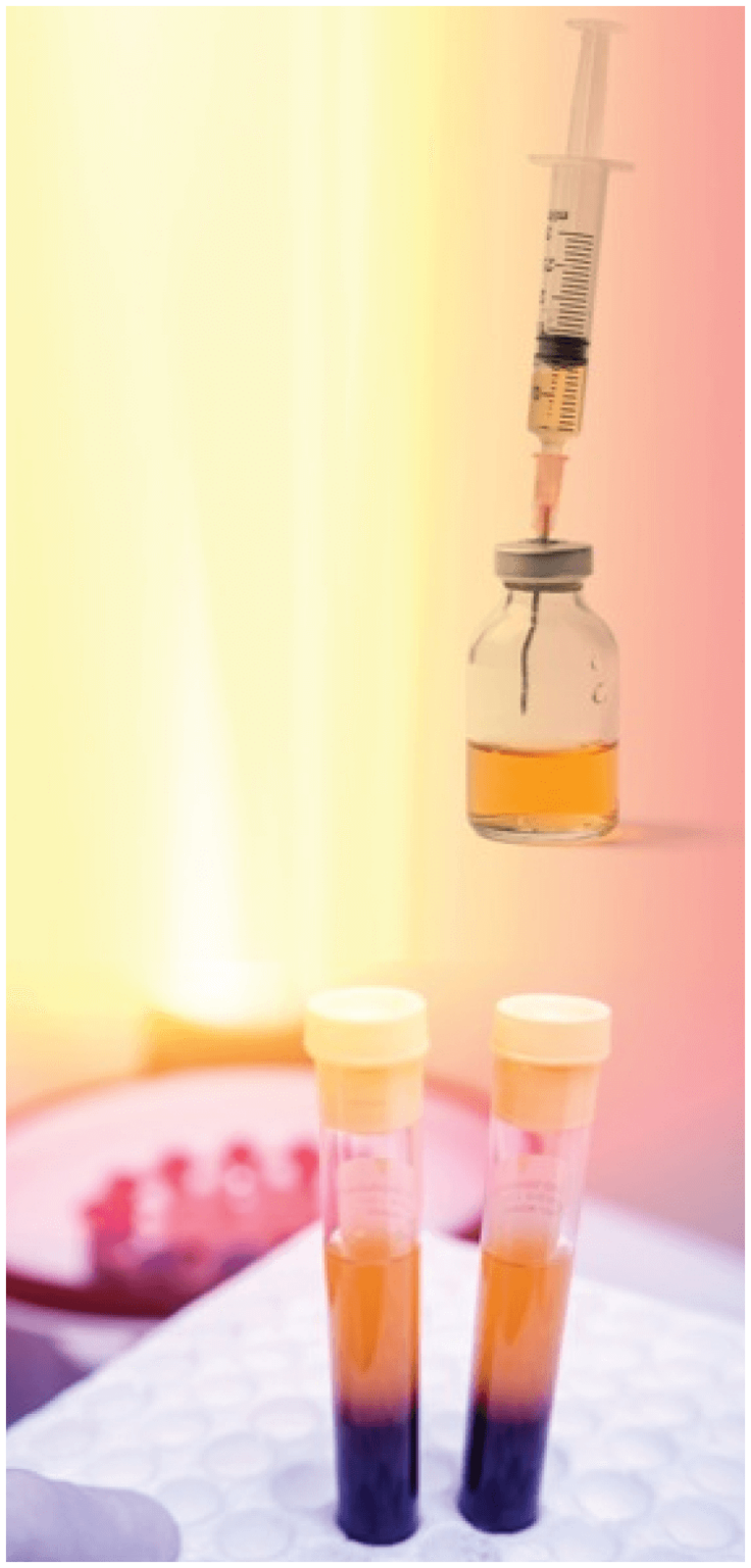 Platelet Lysate Is Made From Your Own Platelet Rich Plasma.