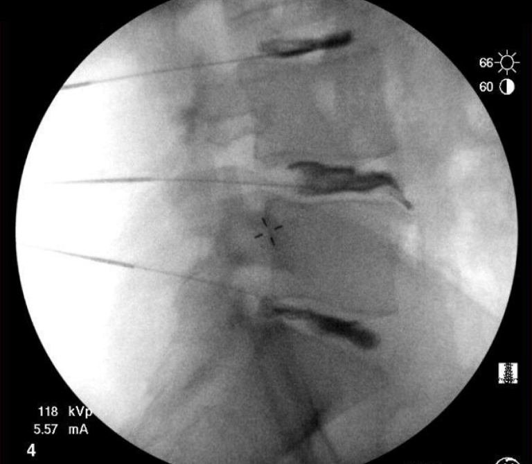 Intradiscal Injections For Lower Back Pain