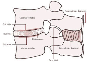 Intradiscal Injections For Lower Back Pain