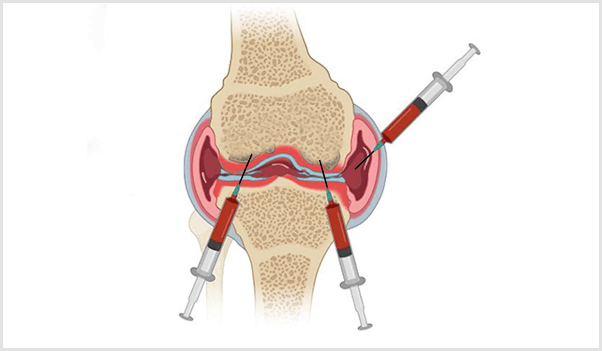 Intraosseous Injections For Advanced Joint Disease